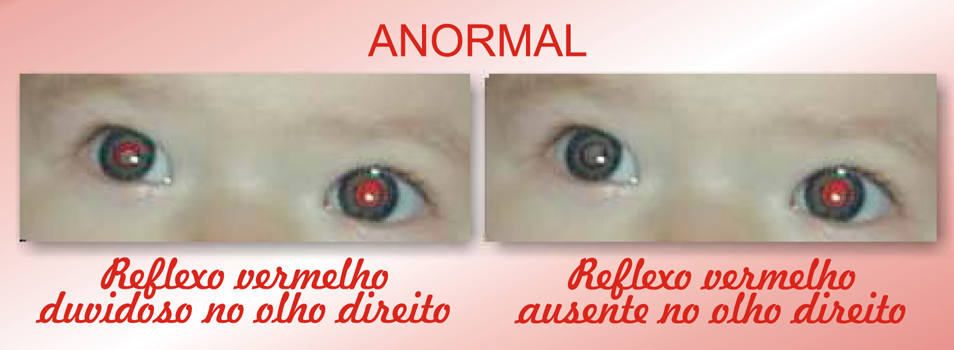 O Teste do Olhinho - MedVisao - Cirurgia Plástica Ocular